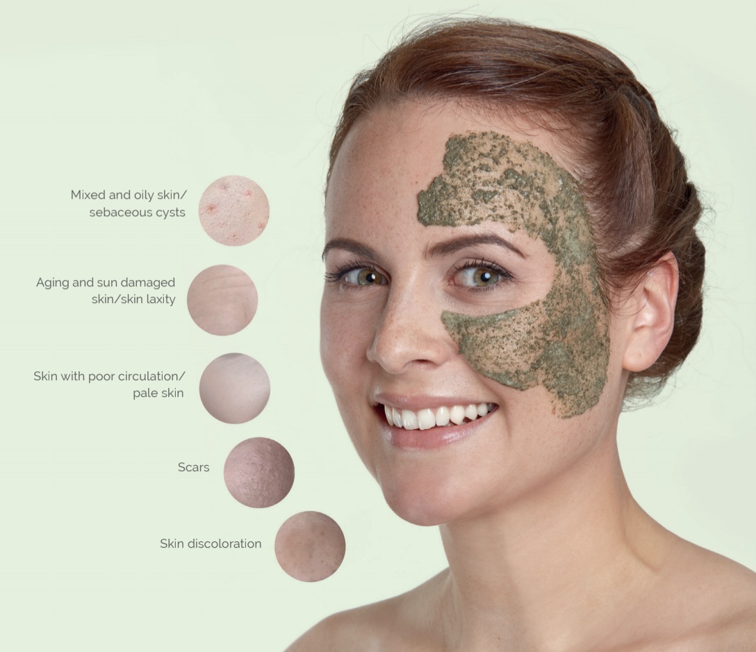 Green Peel – Infinity Medicals